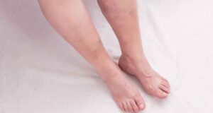 Understanding Chronic Venous Insufficiency (CVI)